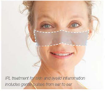 Intense Pulsed Light (IPL) New Treatment Available for Dry Eyes - Black ...